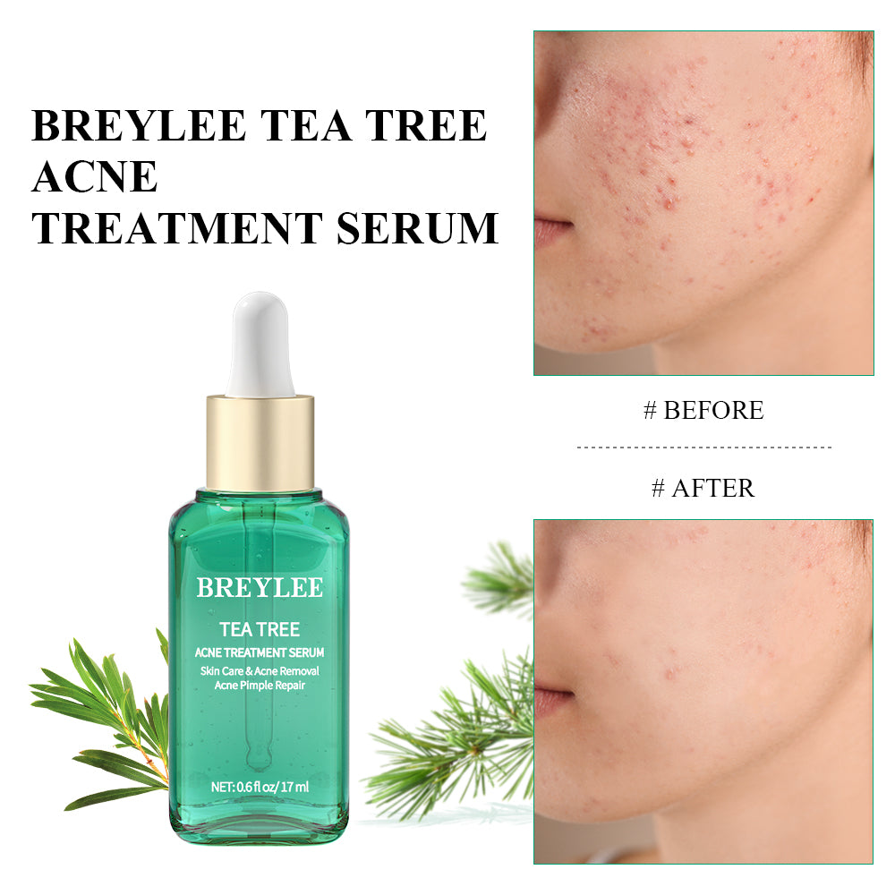 BREYLEE Acne Treatment Serum - Acne Removal & Acne Pimple Repair